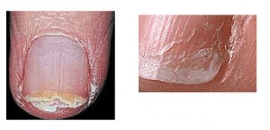 Nail Diseases & Disorders